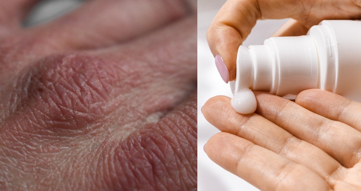 How To Manage Dry Skin This Winter