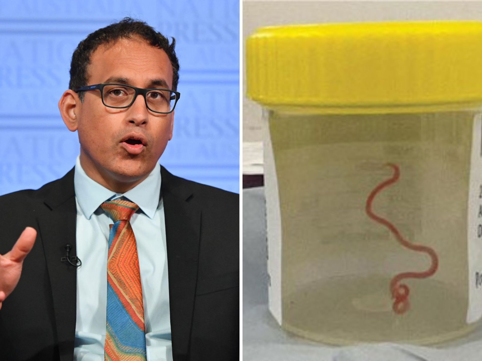 Roundworm removed from woman's brain: 'It was alive and wriggling ...