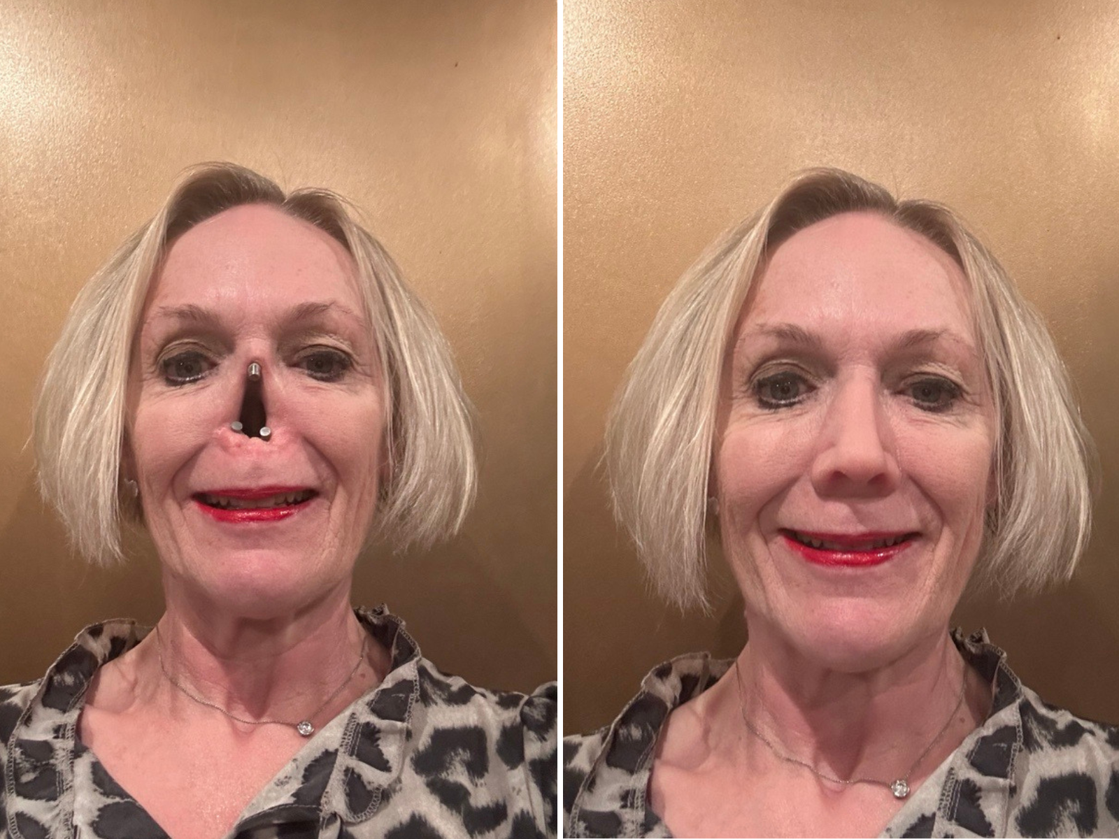 Vasculitis: Why a woman's nose 'completely collapsed in on itself ...