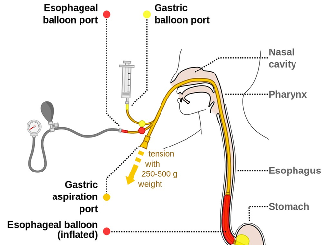 Could Swallowable Gastric Balloons Solve Weight Issues?